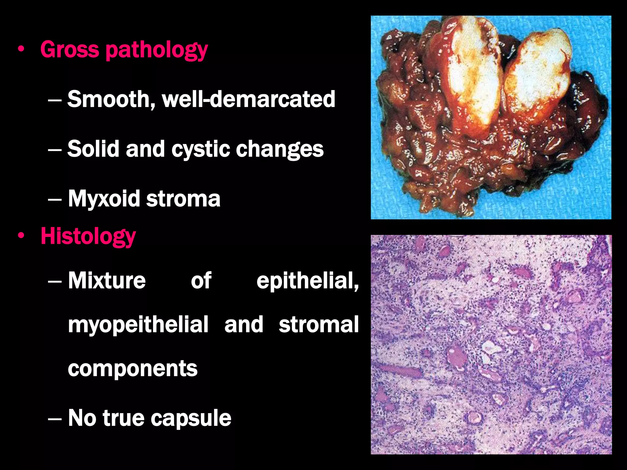 Diseases of salivary glands | PPT