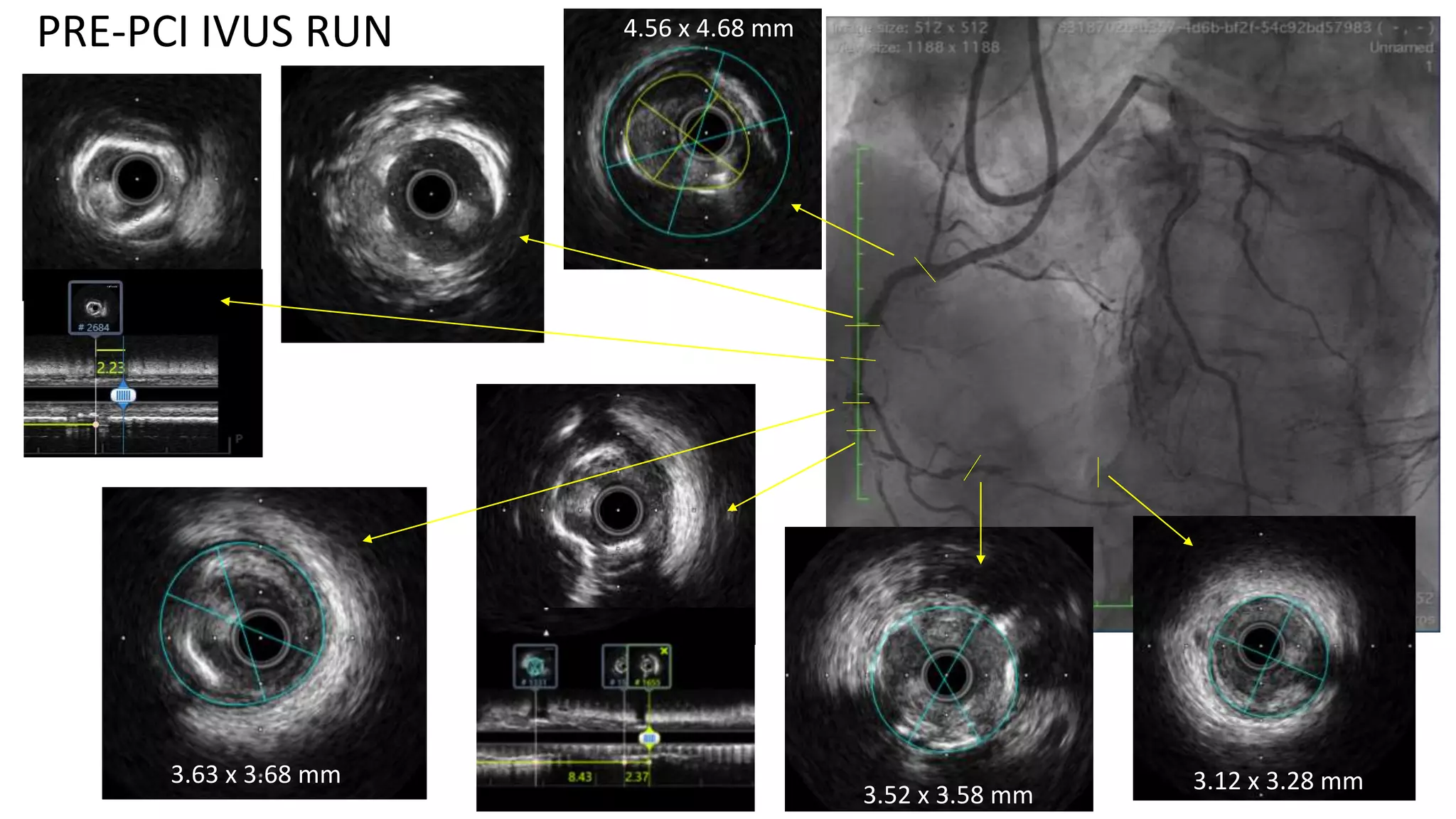 Gabriele Luigi Gasparini - Contrast-associated kidney injury ...
