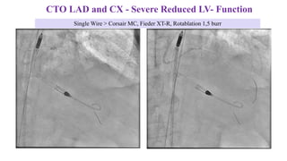 Mohamed Ayoub: The patient with severe LV dysfunction | PPTX