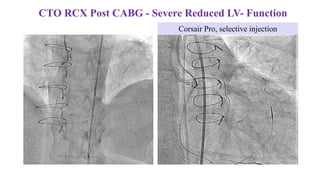 Mohamed Ayoub: The patient with severe LV dysfunction | PPTX