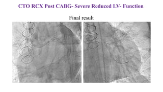 Mohamed Ayoub: The patient with severe LV dysfunction | PPTX