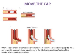 Roberto Garbo: How to overcome proximal cap ambiguity? | PDF