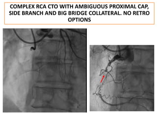 Roberto Garbo: How to overcome proximal cap ambiguity? | PDF