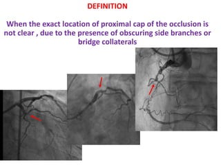 Roberto Garbo: How to overcome proximal cap ambiguity? | PDF