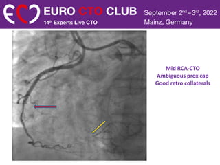Roberto Garbo: How to overcome proximal cap ambiguity? | PDF