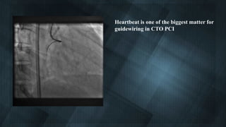 Kenya Nasu: IVUS controlled re-entry in antegrade CTO PCI | PPT