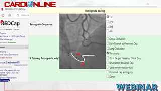 Sevket Görgülü: Severe angulations including the proximal cap | PPT