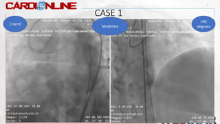 Sevket Görgülü: Severe angulations including the proximal cap | PPT