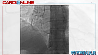 Sevket Görgülü: Severe angulations including the proximal cap | PPT