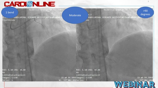 Sevket Görgülü: Severe angulations including the proximal cap | PPT