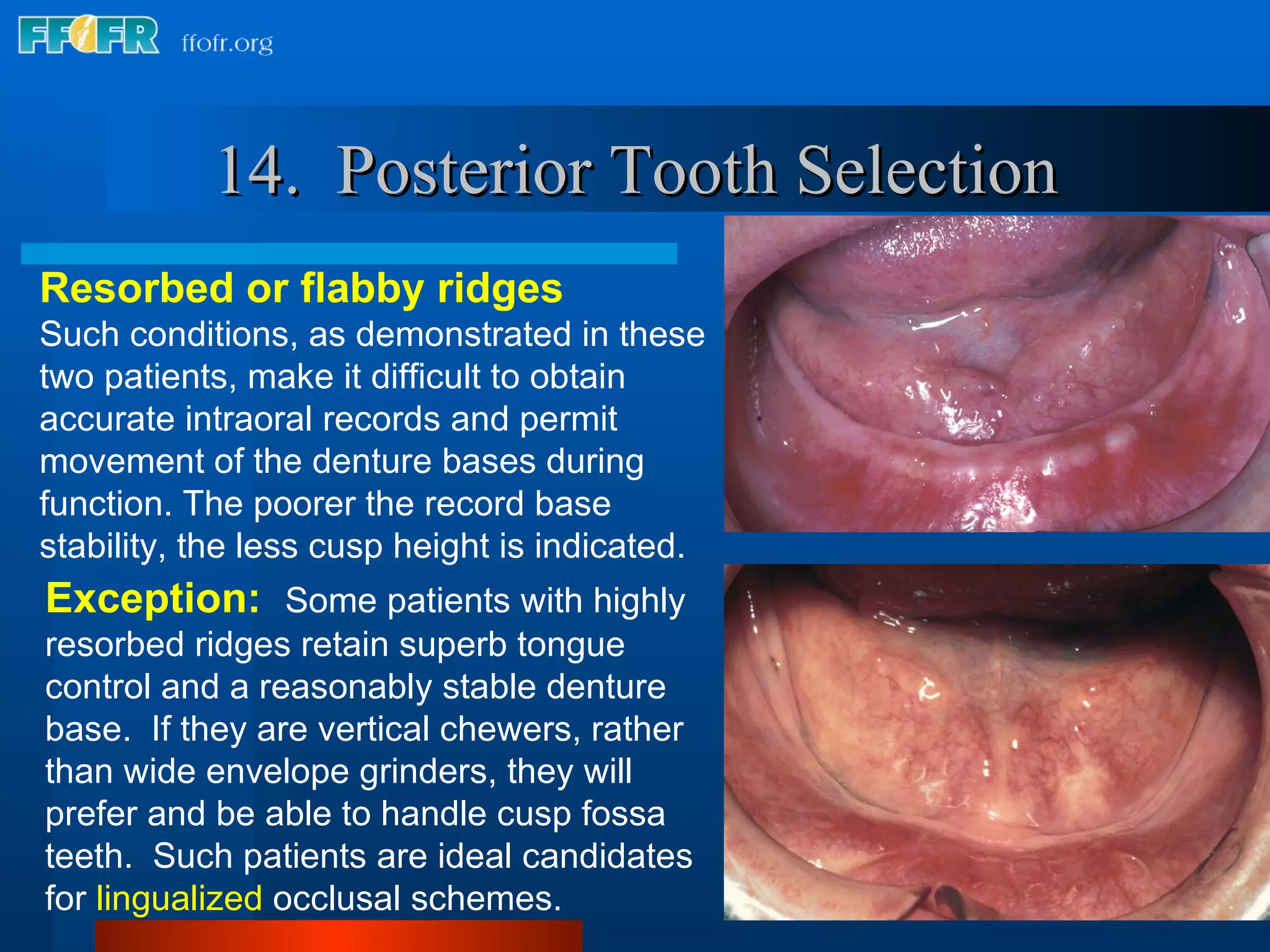 22.criteria for posterior tooth selection | PPT