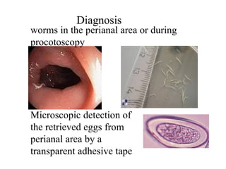 22-Enterobiasis presentation on parasitology | PPT