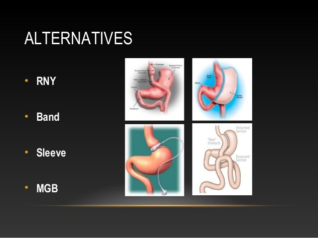 Gastric Bypass Billroth I Versus Billroth Ii Anatomy