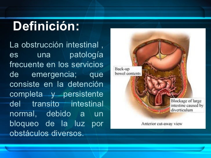Obstrucción Intestinal: Síntomas Y Signos – VNUMS