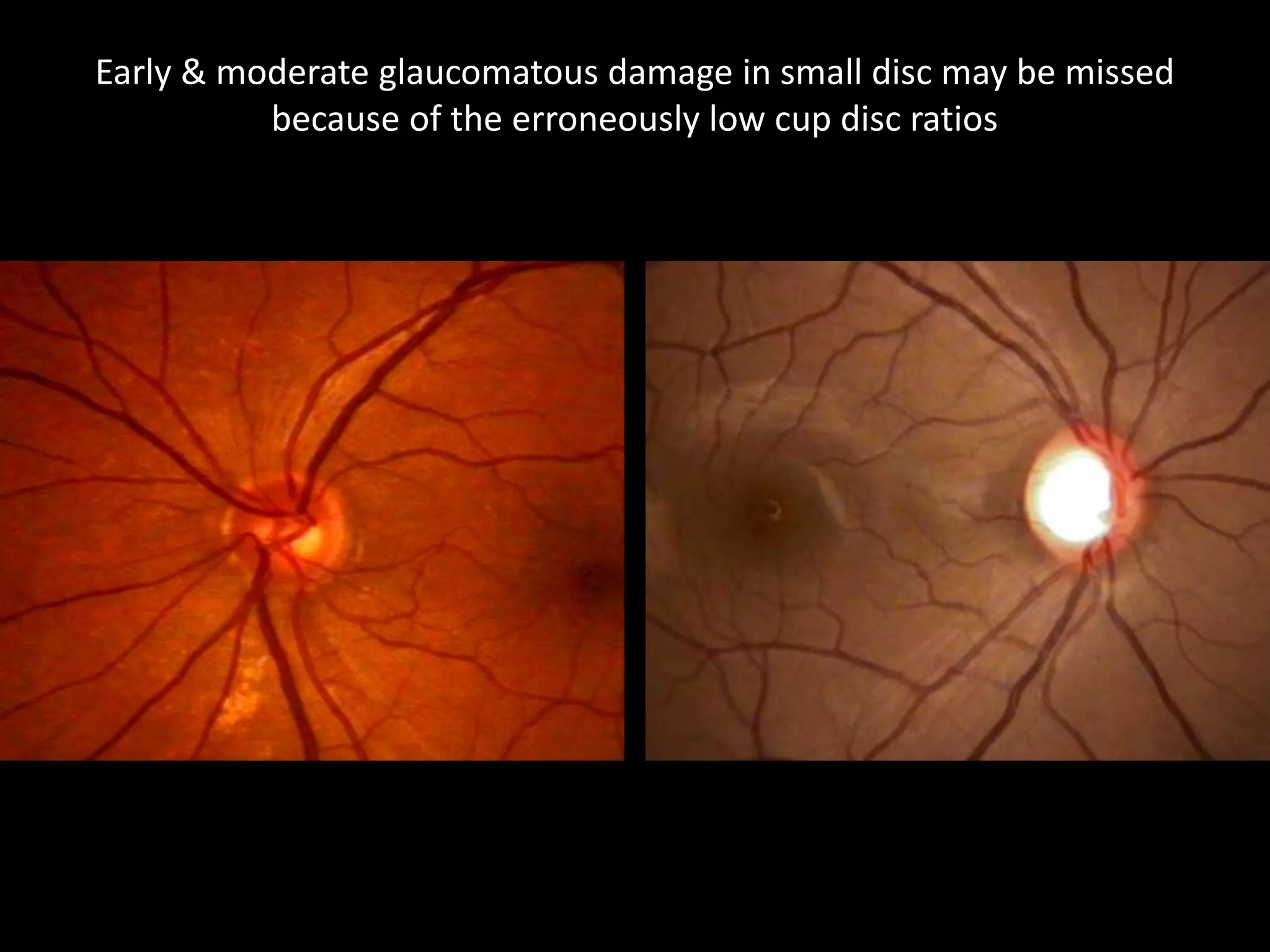 22 optic-disc-evaluation-in-glaucoma | PPT