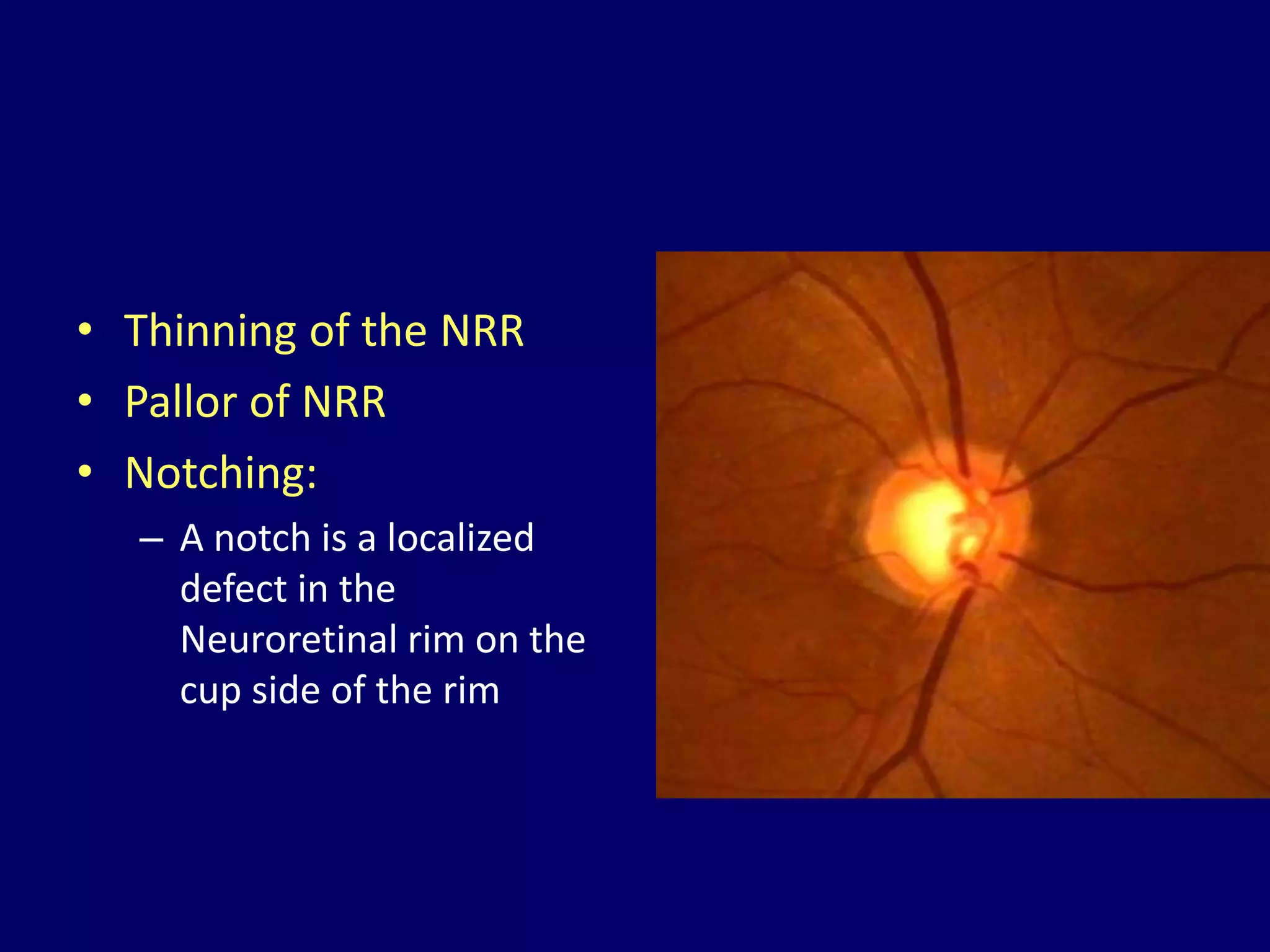 22 optic-disc-evaluation-in-glaucoma | PPT