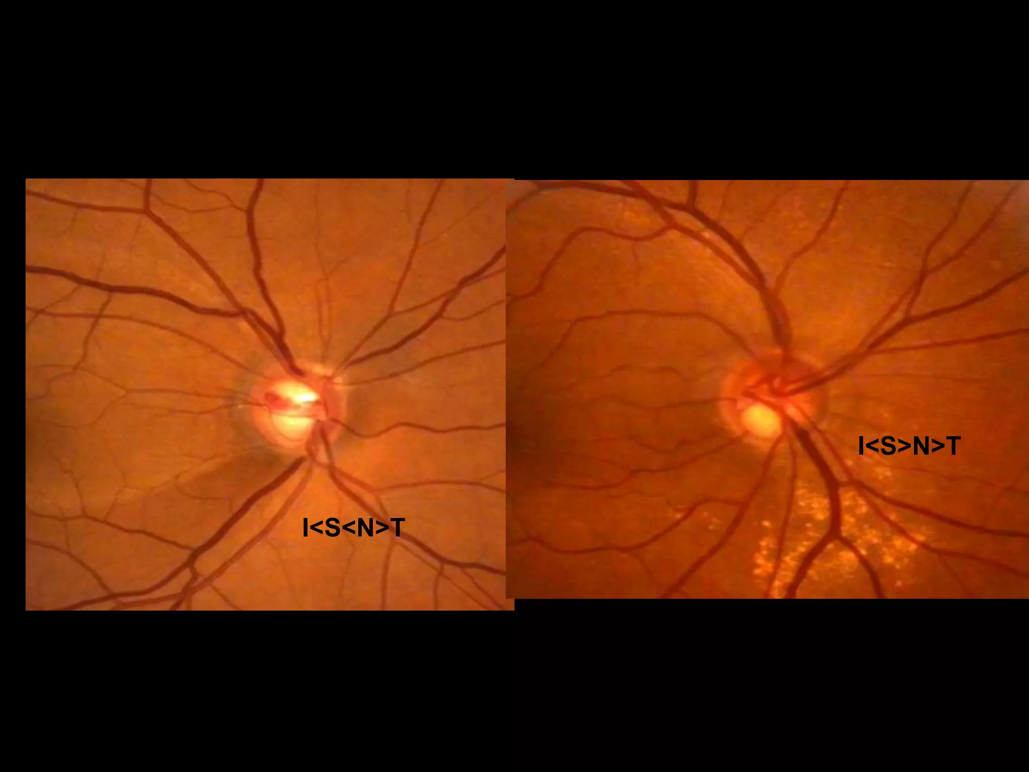 22 optic-disc-evaluation-in-glaucoma | PPT
