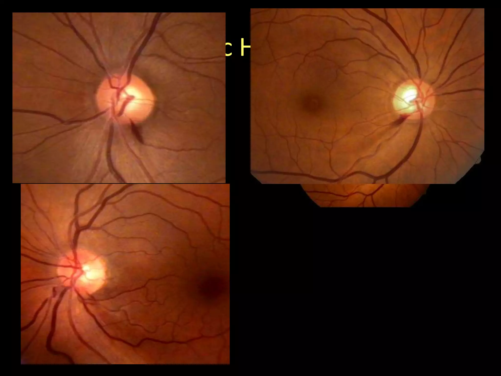 22 optic-disc-evaluation-in-glaucoma | PPT