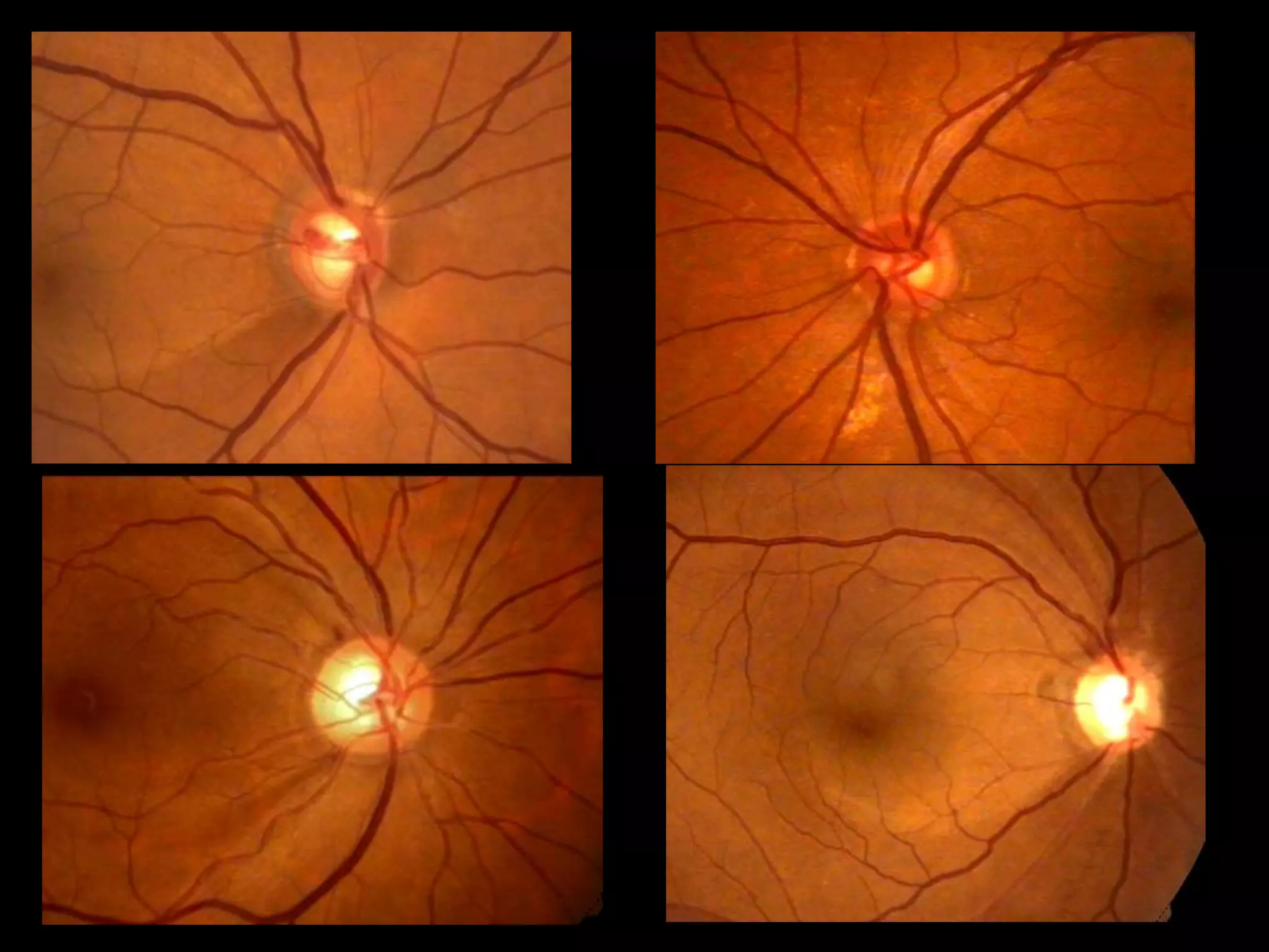 22 optic-disc-evaluation-in-glaucoma | PPT