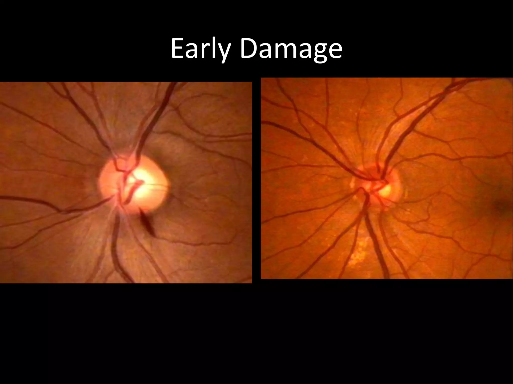22 optic-disc-evaluation-in-glaucoma | PPT