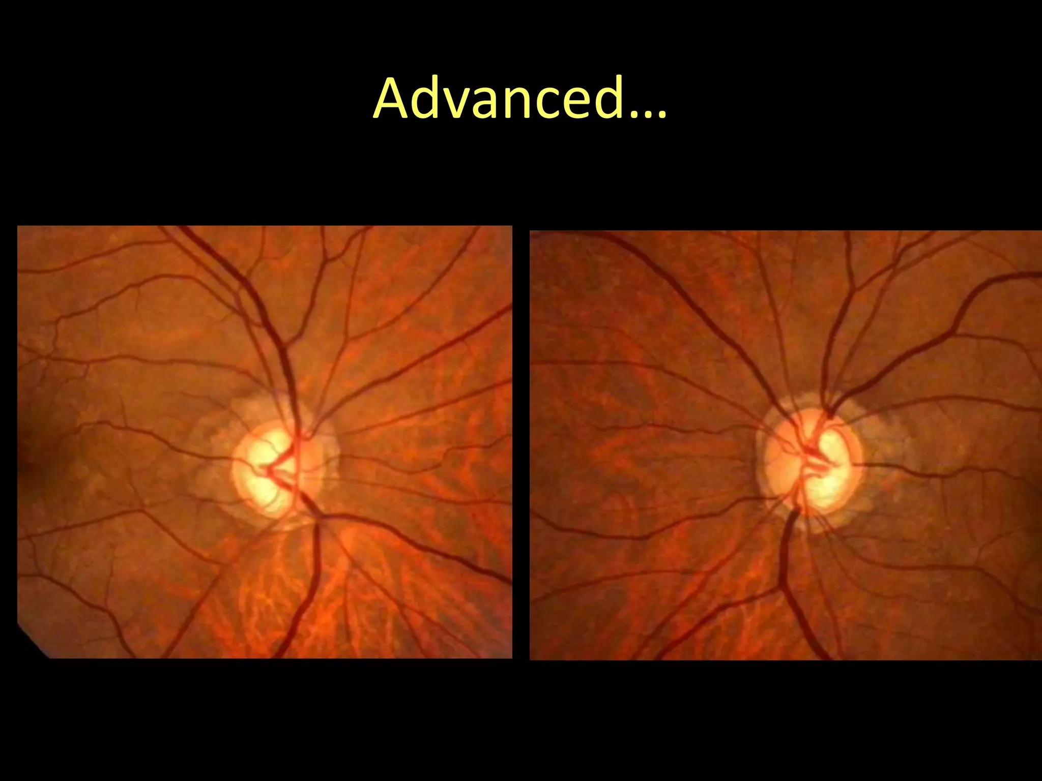 22 optic-disc-evaluation-in-glaucoma | PPT