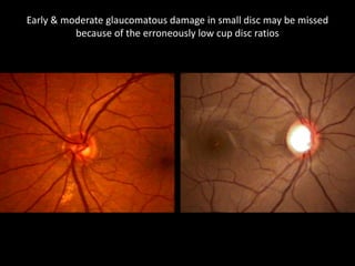 22 optic-disc-evaluation-in-glaucoma | PPT