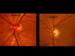 22 optic-disc-evaluation-in-glaucoma | PPT