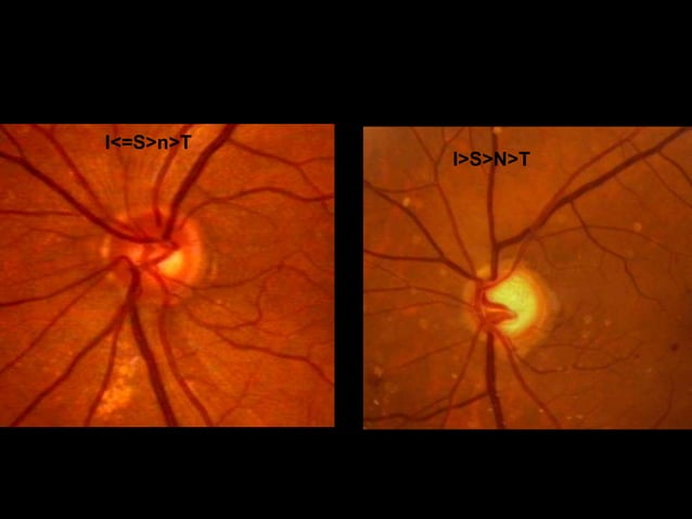 22 optic-disc-evaluation-in-glaucoma | PPT