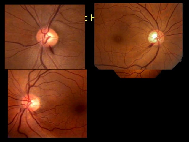 22 optic-disc-evaluation-in-glaucoma | PPT