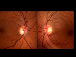 22 optic-disc-evaluation-in-glaucoma | PPT