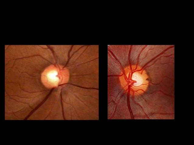 22 optic-disc-evaluation-in-glaucoma | PPT