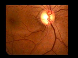 22 optic-disc-evaluation-in-glaucoma | PPT