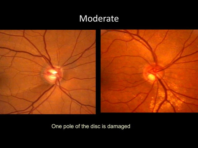 22 optic-disc-evaluation-in-glaucoma | PPT