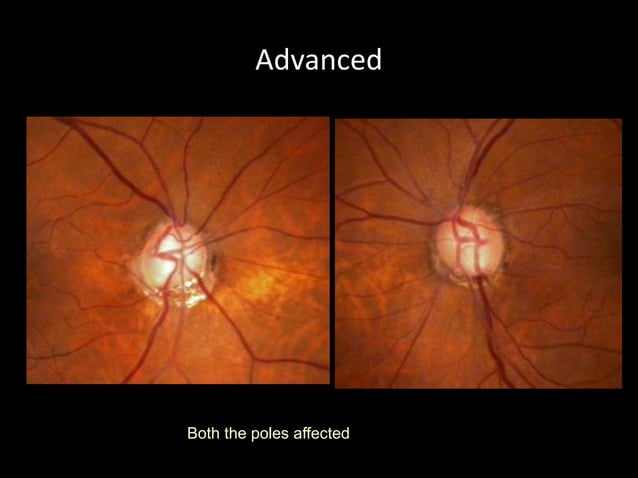22 optic-disc-evaluation-in-glaucoma | PPT