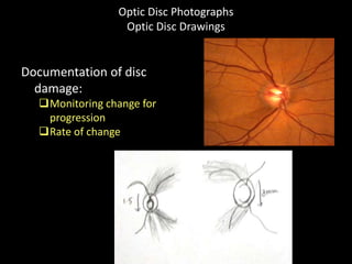 22 optic-disc-evaluation-in-glaucoma | PPT