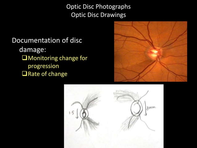 22 optic-disc-evaluation-in-glaucoma | PPT