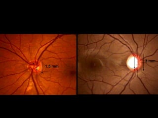 22 optic-disc-evaluation-in-glaucoma | PPT