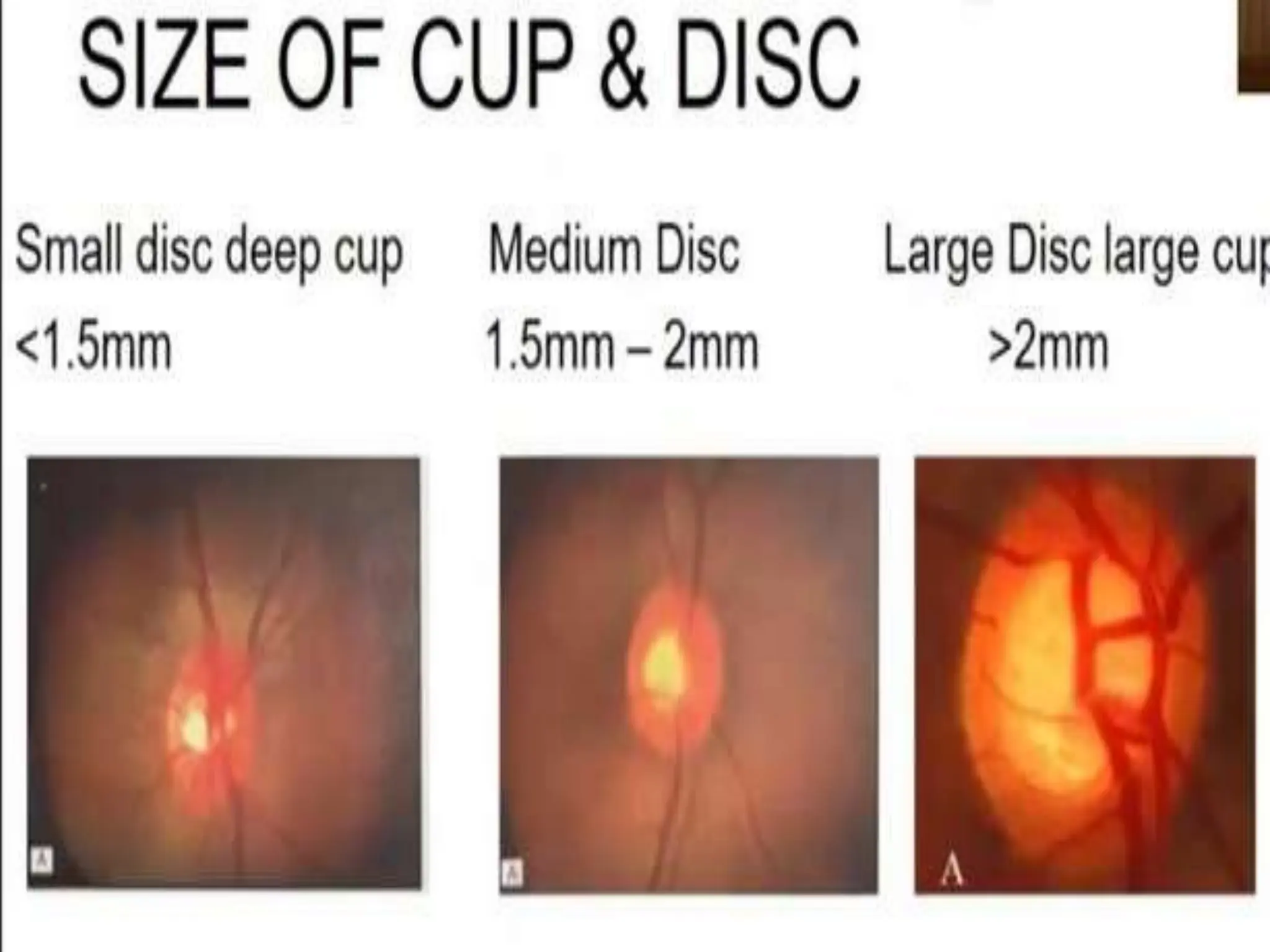22-Optic-Disc-Evaluation-IN-Glaucoma.ppt