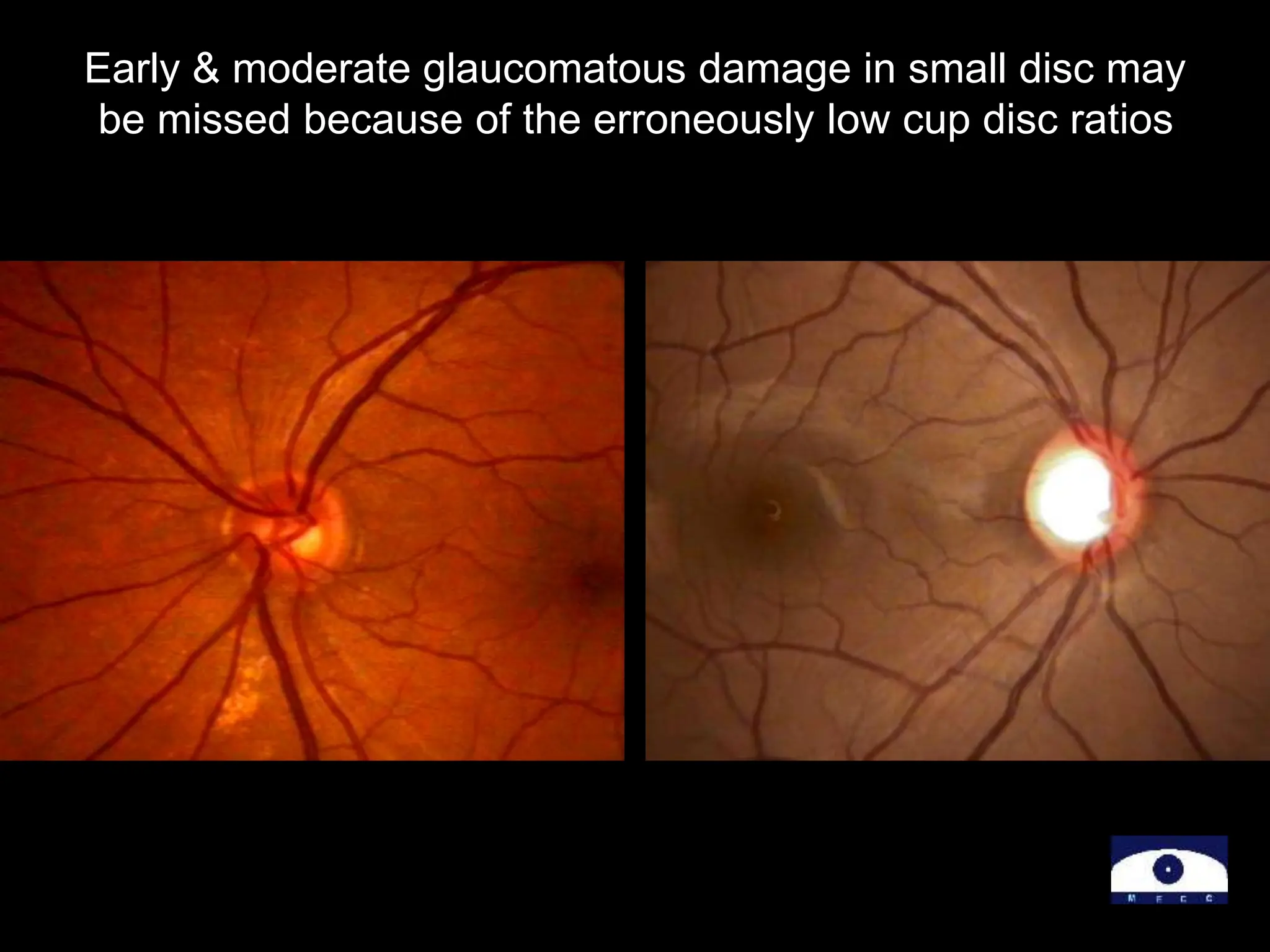 22-Optic-Disc-Evaluation-IN-Glaucoma.ppt