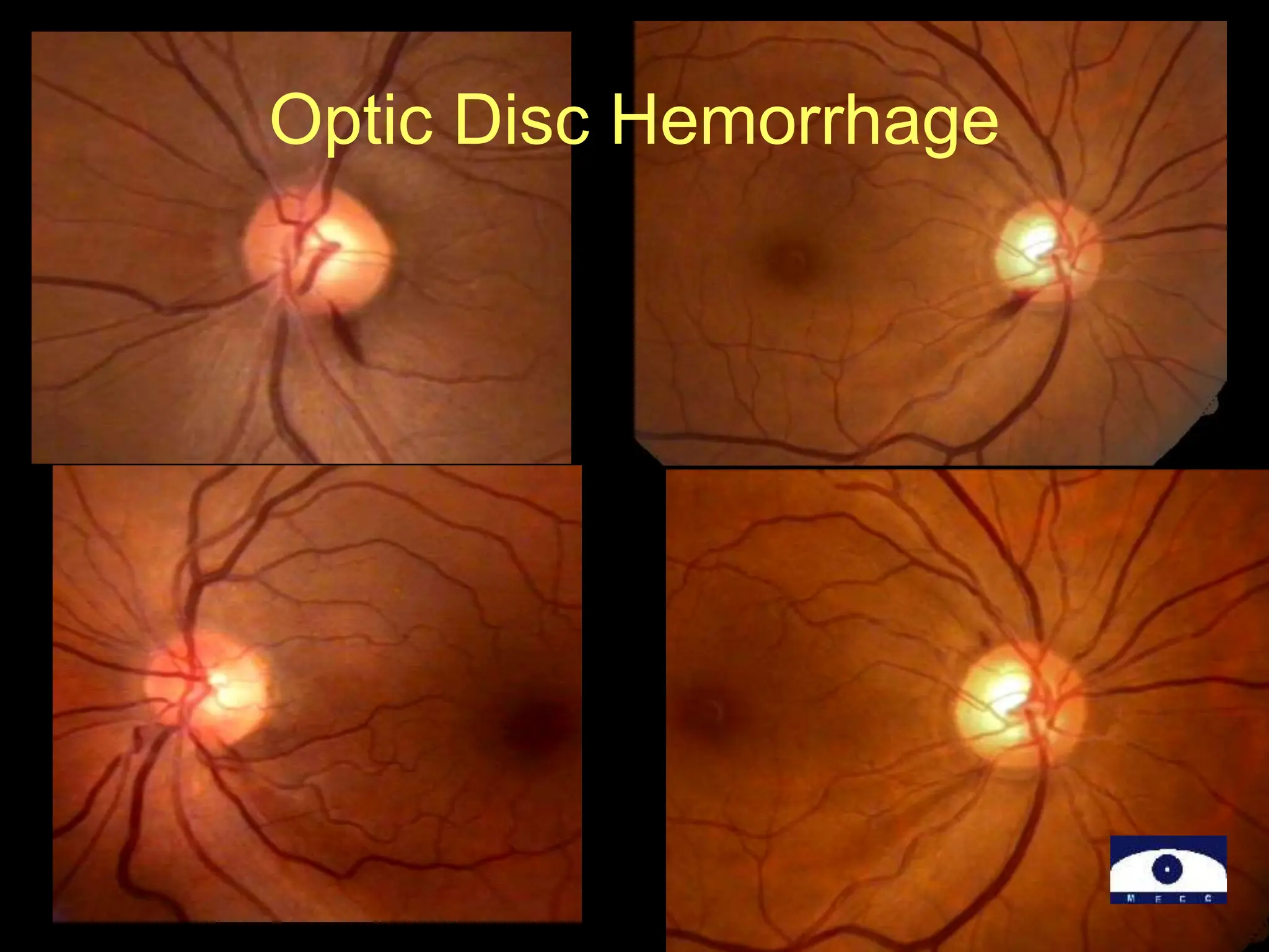 22 Optic Disc Evaluation In Glaucomappt