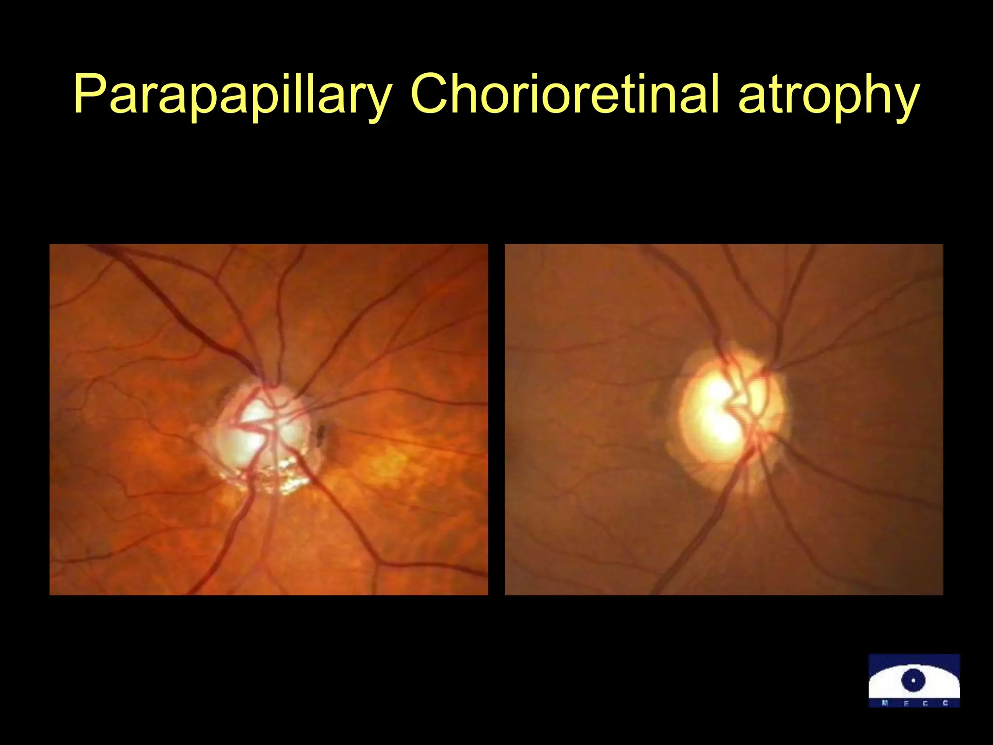 22-Optic-Disc-Evaluation-IN-Glaucoma.ppt