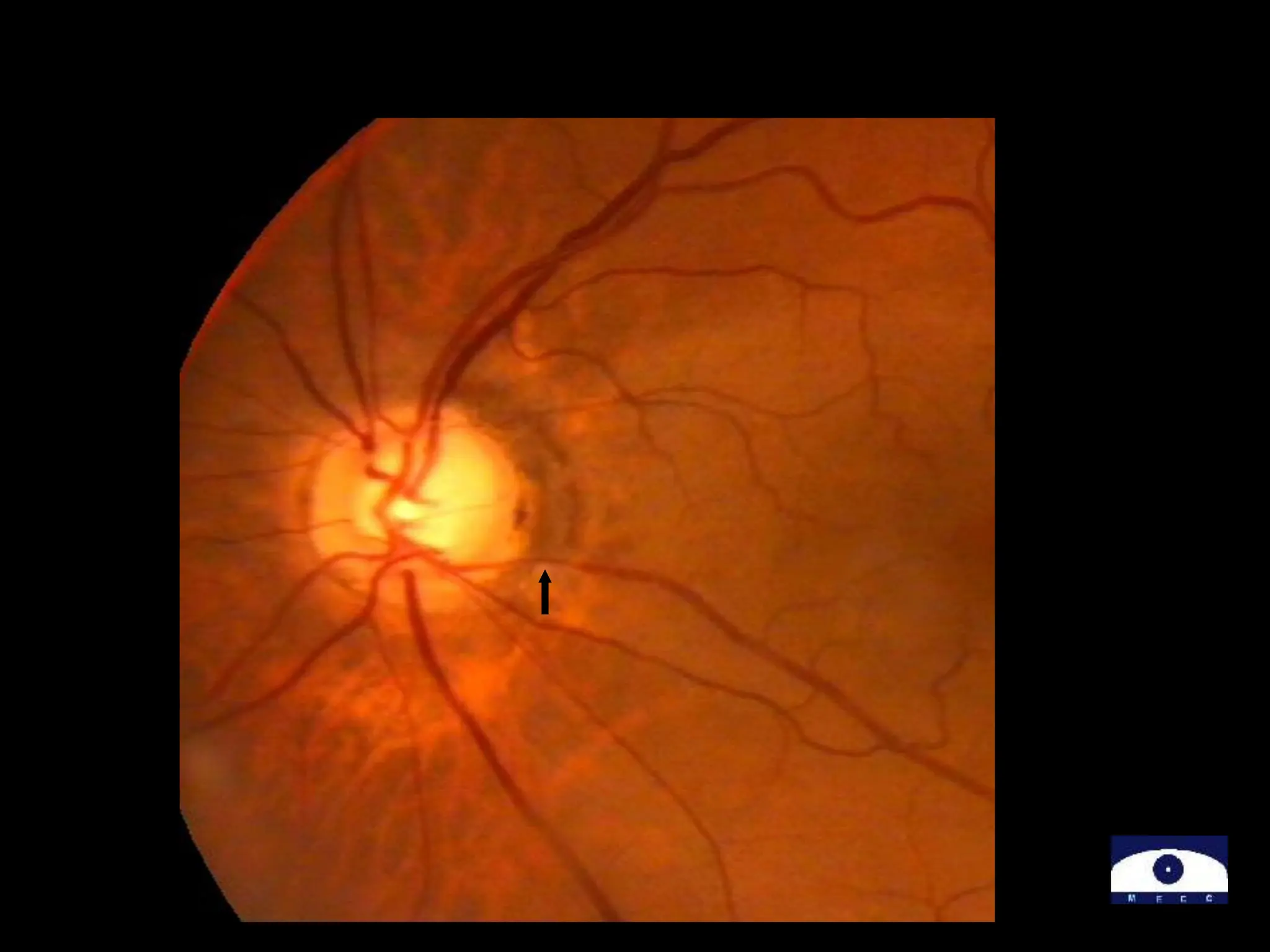22-Optic-Disc-Evaluation-IN-Glaucoma.ppt