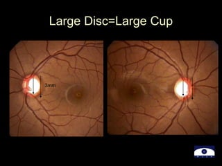 22-Optic-Disc-Evaluation-IN-Glaucoma.ppt