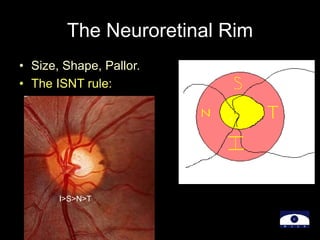 22-Optic-Disc-Evaluation-IN-Glaucoma.ppt