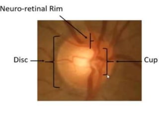 22-Optic-Disc-Evaluation-IN-Glaucoma.ppt