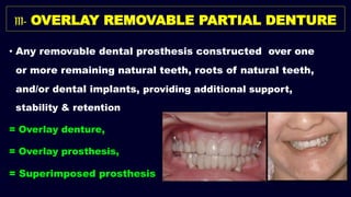 Other forms of removable partial denture | PPTX
