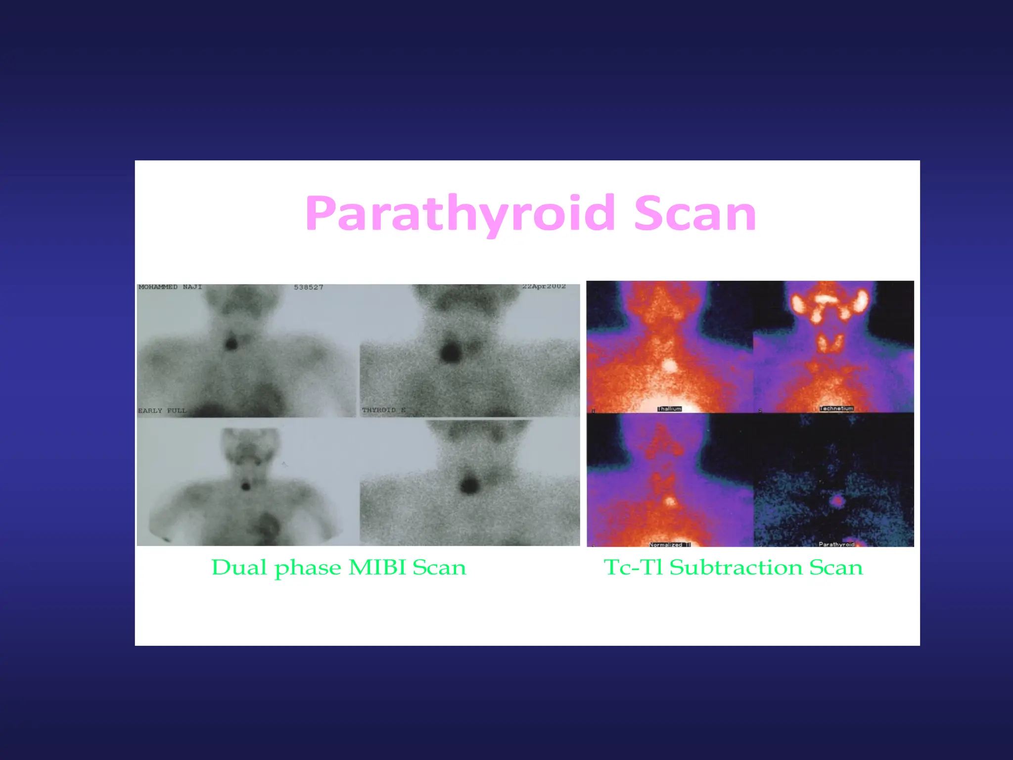 22-Parathyroid Disorders.ppt.pdf and parathyroid carcinoma | PPT