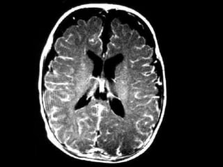 22 Purulent Meningitis | PPT | Brain and Nervous System Disorders ...
