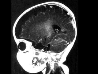 22 Purulent Meningitis | PPT | Brain and Nervous System Disorders ...