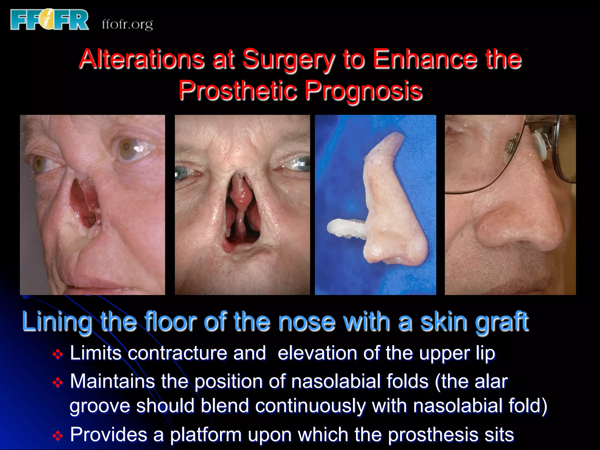 Restoration of Facial Defects - Basic Priniciples | PDF
